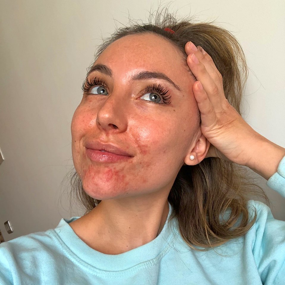 Ángela Duarte sorprende al mostrar su rostro con acné, sin filtros ni ...