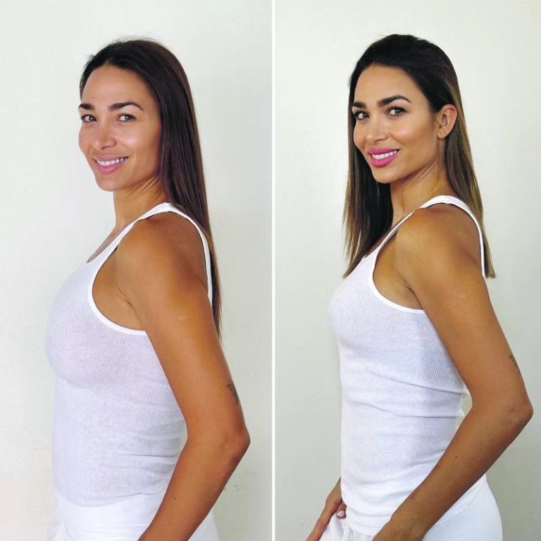 El antes y después de Lisandra Silva tras quitarse los implantes ...