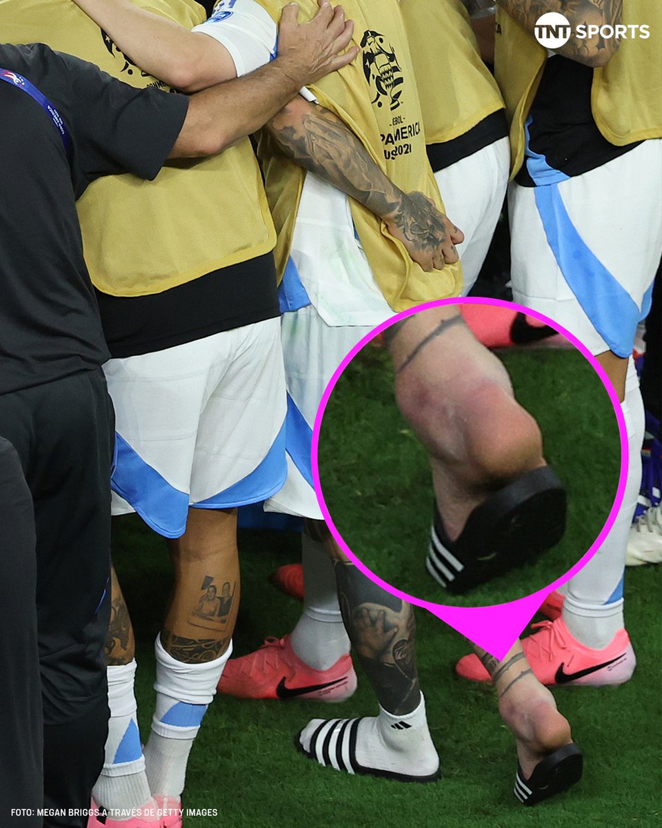 Fotos: Así quedó el tobillo de Lionel Messi tras lesión que sufrió en ...